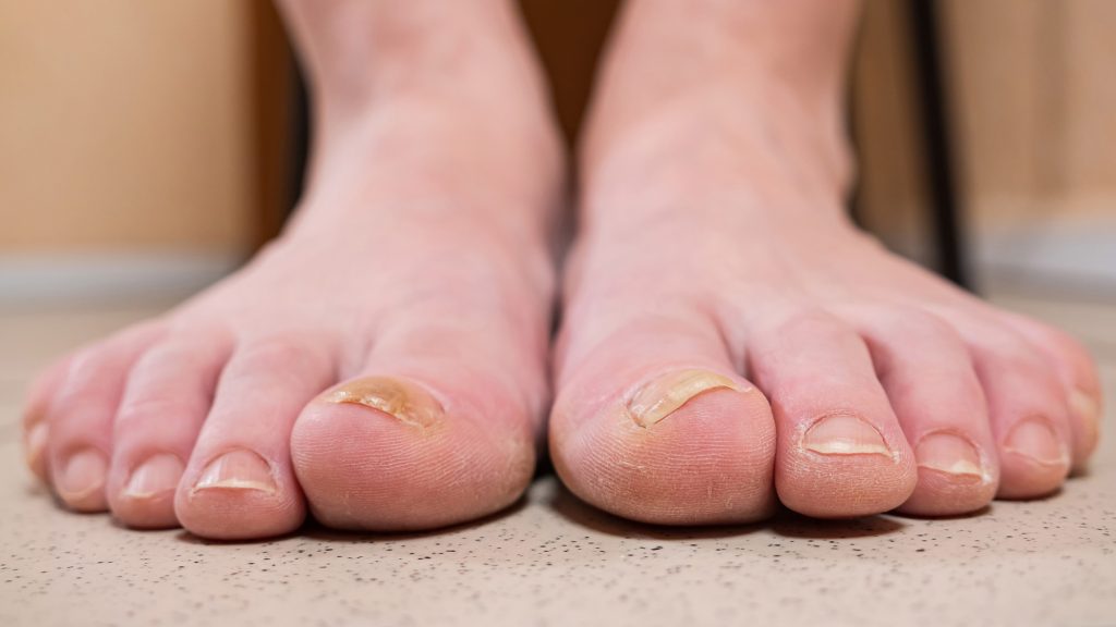 Toe Nail Conditions – Burrard Podiatry